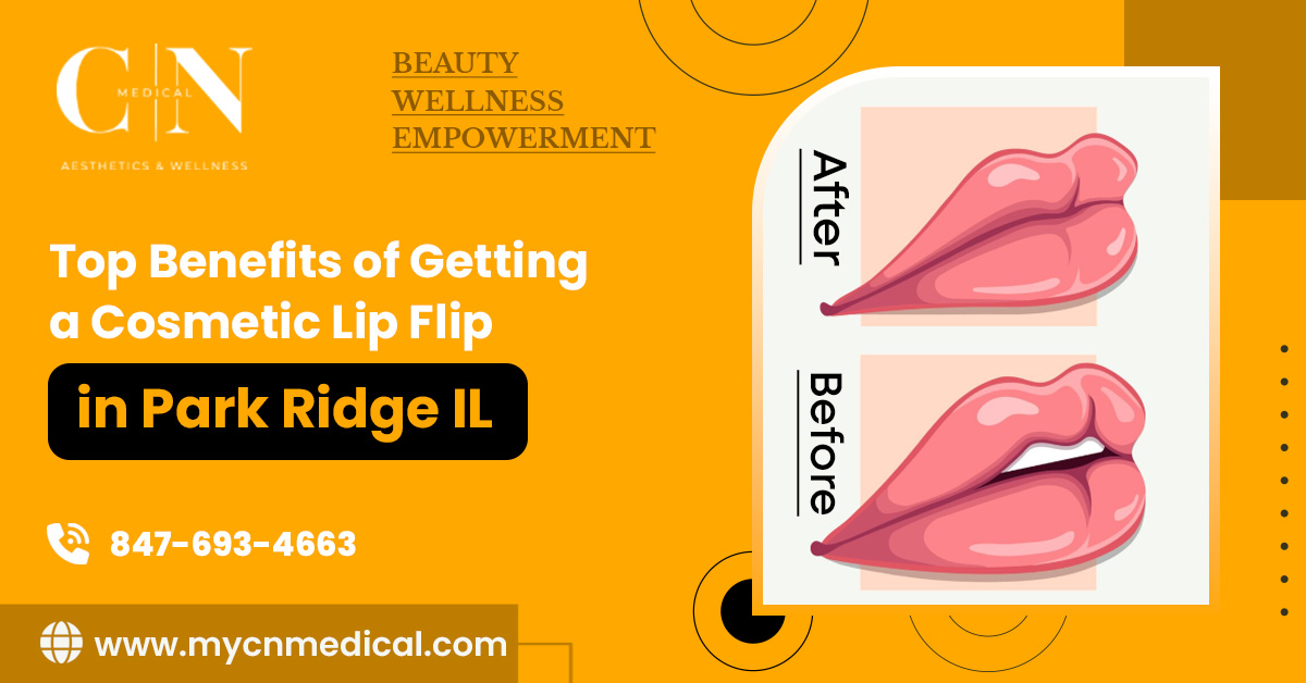 Benefits of a Lip Flip in Park Ridge IL | CN Medical Aesthetics