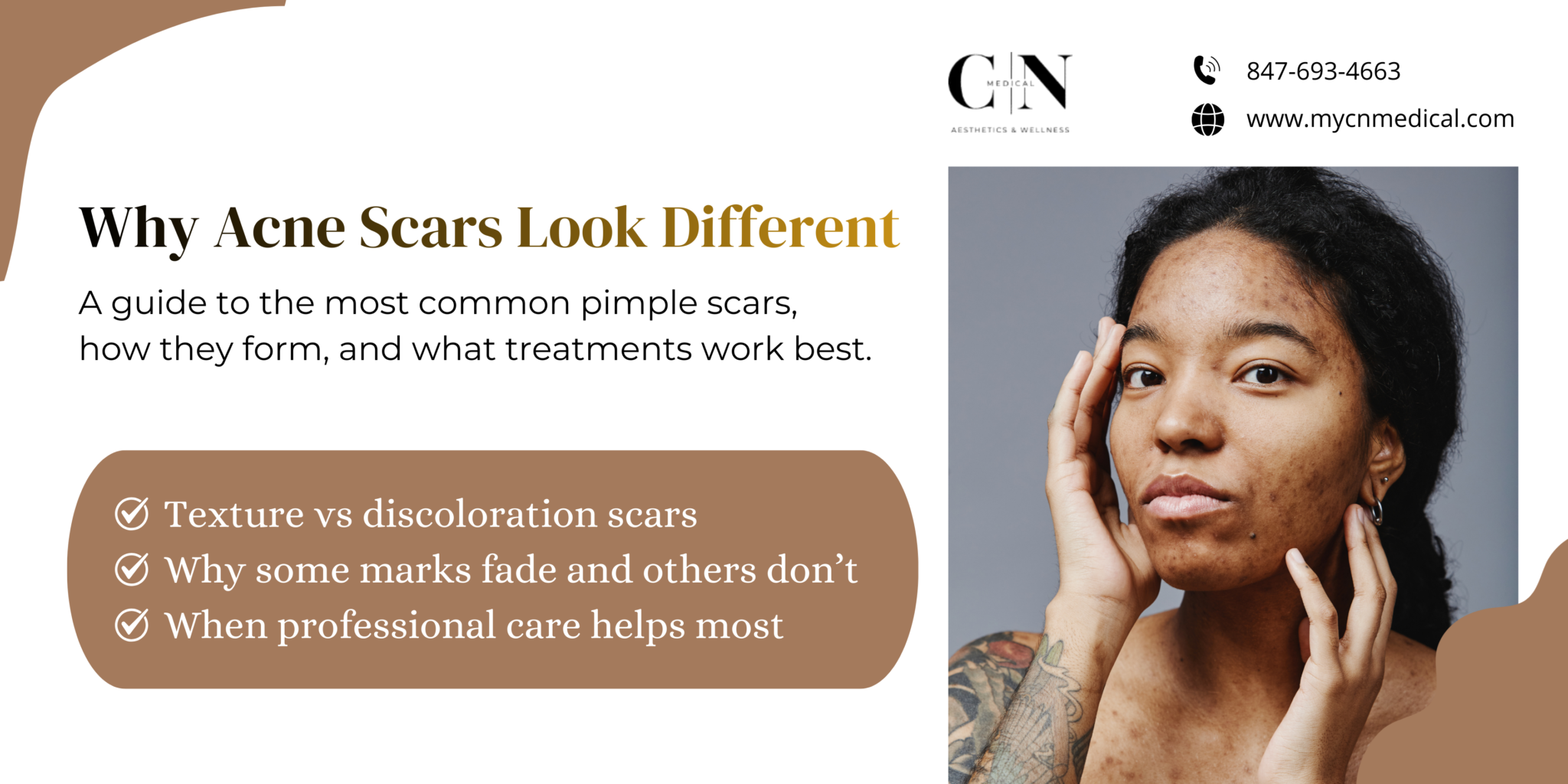 Types of Acne Scars: Understanding Pimple Scars and Treatments